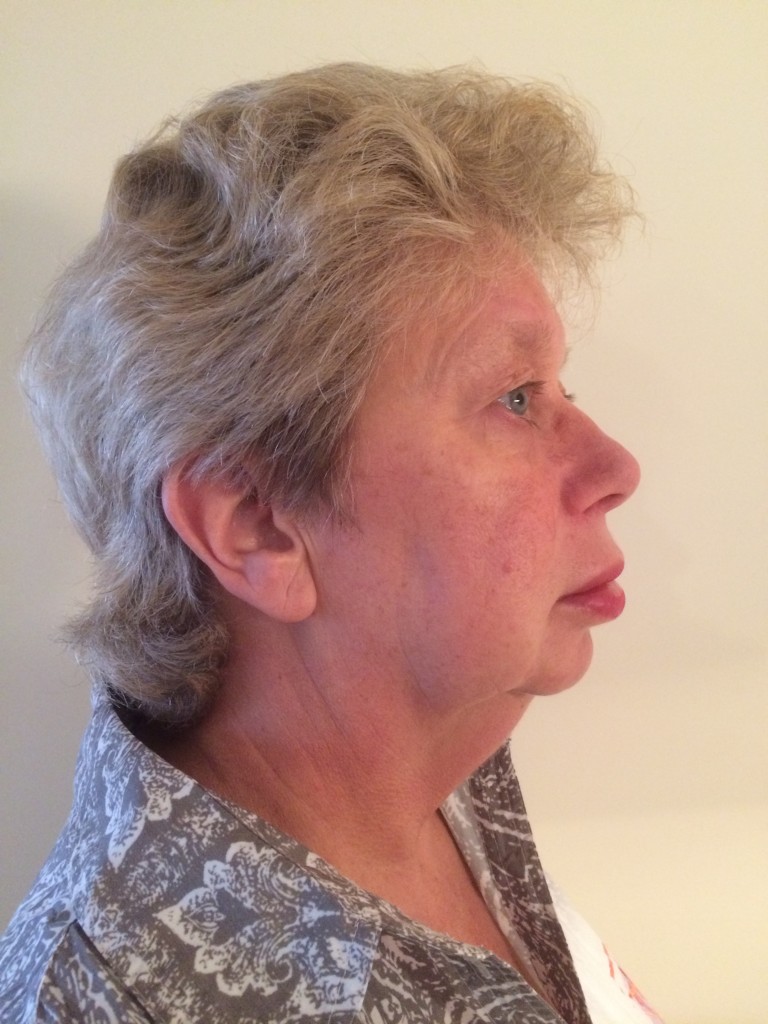 foto’s tong, gezicht, sonde en gebit | Tongkanker, verhalen hoofd ...